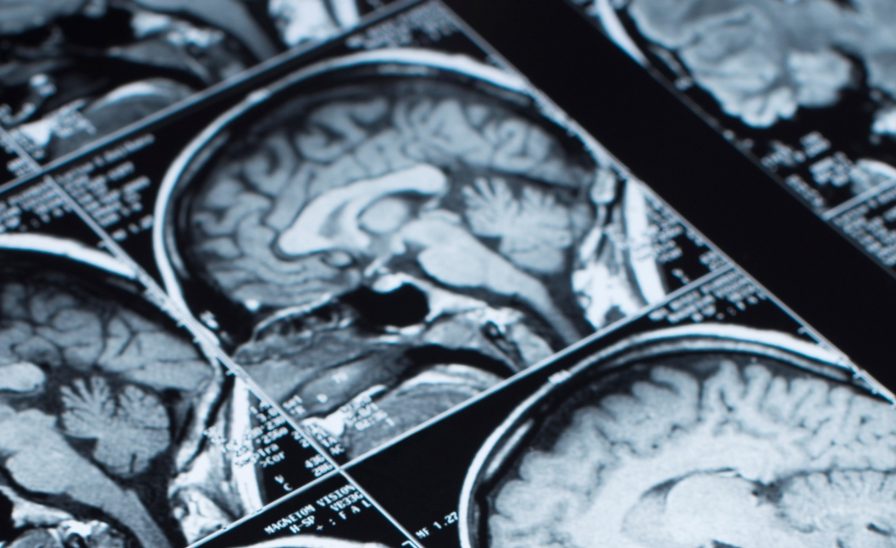 Breast Cancer Brain Metastases: Clinical Challenges and Recent ...